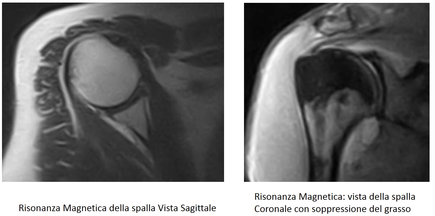 Risonanza Magnetica della spalla - Centro Medico Arcidiacono